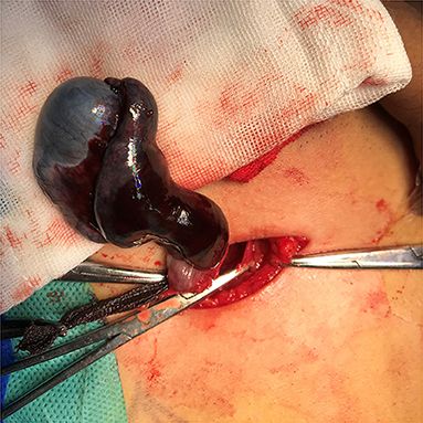 post orchiectomy problems