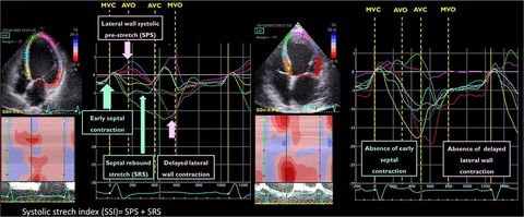 intraventricular dyssynchrony