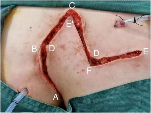 pilonidal sinus surgery types