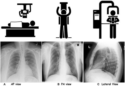 bronchitis x ray report format
