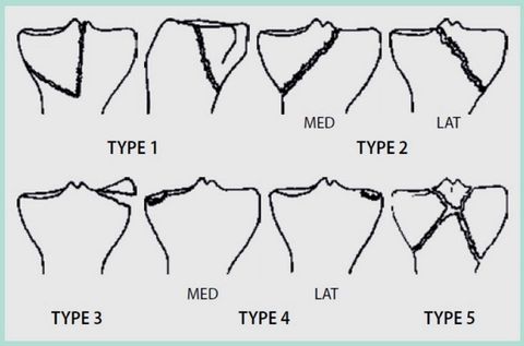open tibia fracture types