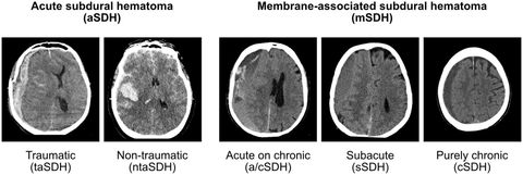 acute chronic sdh