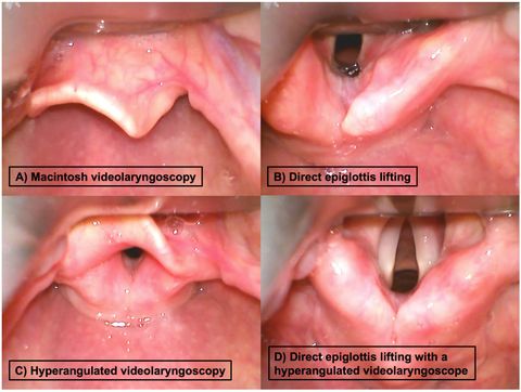 intubation view scale