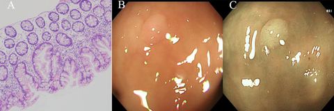 hyperplastic polyp with serrated features