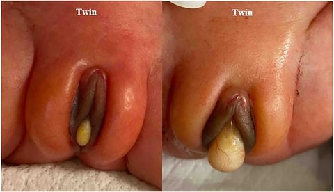 microperforate hymen causes