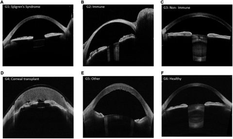 anterior segment oct interpretation