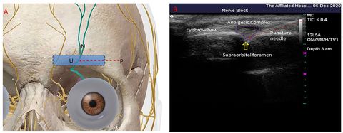 nasociliary nerve block