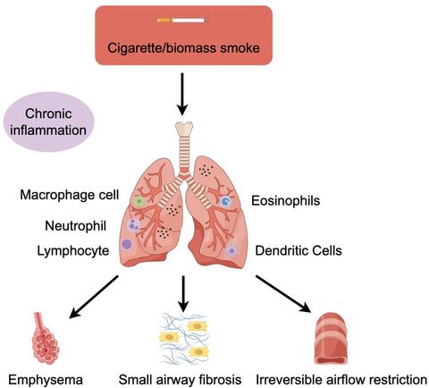 emphysema pathophysiology article