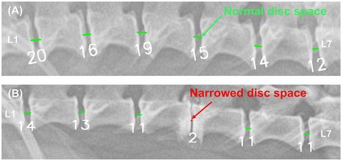 intervertebral disc space