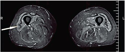 myositis mri protocol