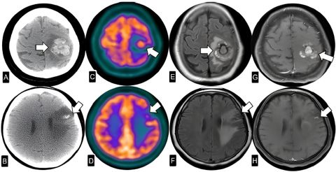 carney complex radiology