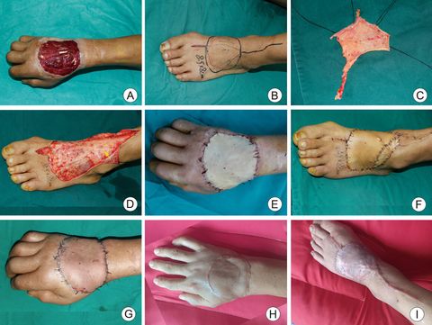 venous flow through flap