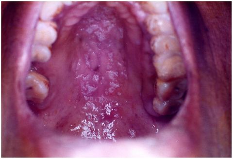 chronic hyperplastic candidiasis