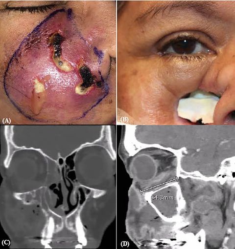orbital exenteration procedure