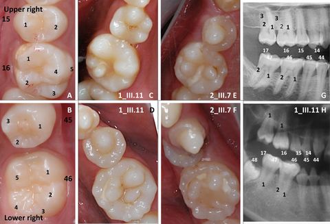 deciduous teeth cusps