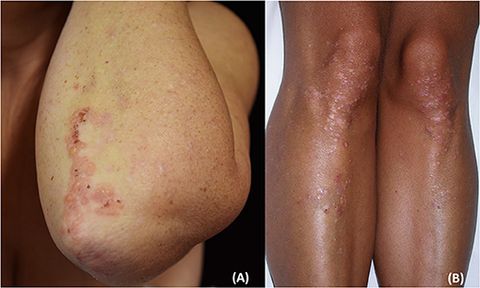 dermatitis hepretiformis