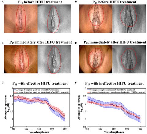 vulvar dystrophy causes