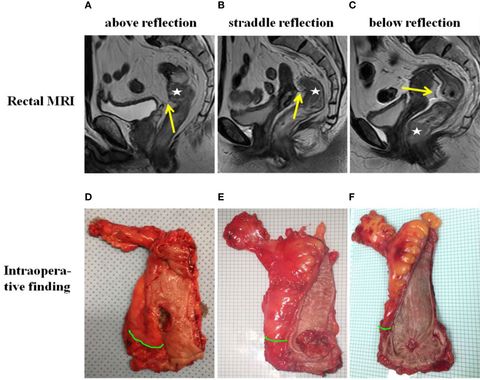 peritoneal reflection sigmoid