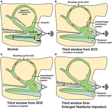 third window syndrome nhs