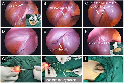 hydrocelectomy procedure steps