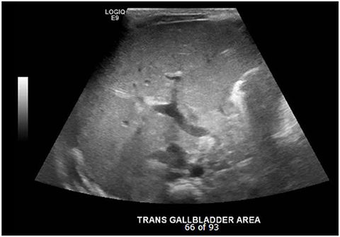 gallbladder uss