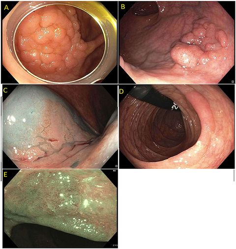 colonoscopy polyps benign
