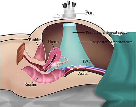 extraperitoneal laparoscopy