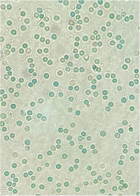 G6pd Deficiency Heinz Bodies