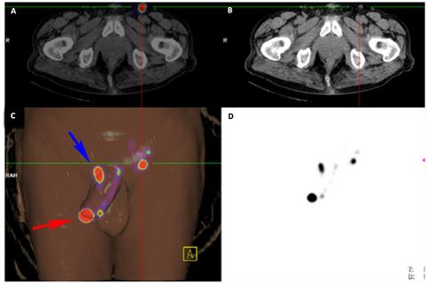 penile cancer staging radiology
