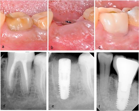 interradicular bone teeth