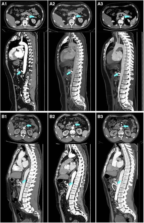 dissection celiac artery