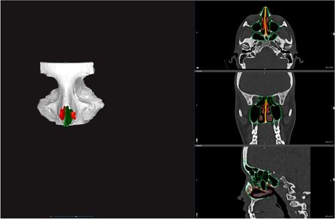 maxillary sinus 3d