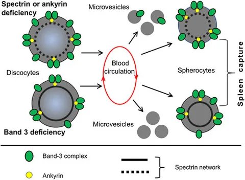 Spherocytes Hereditary Spherocytosis